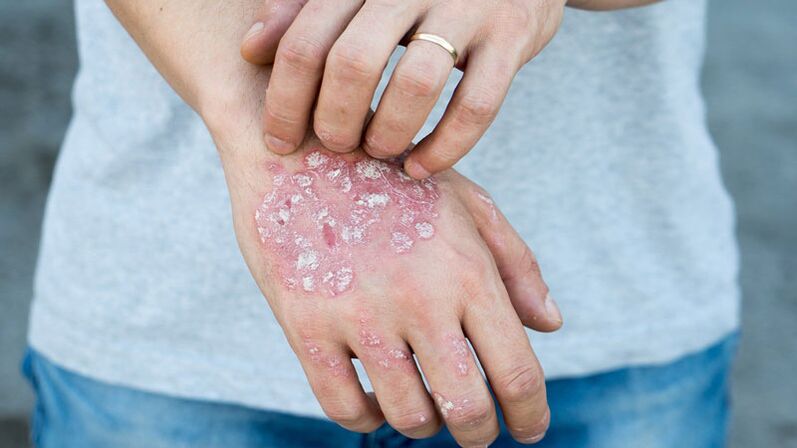 Psoriáza. Druhy, příčiny, symptomy a příznaky, diagnostika a léčba ...